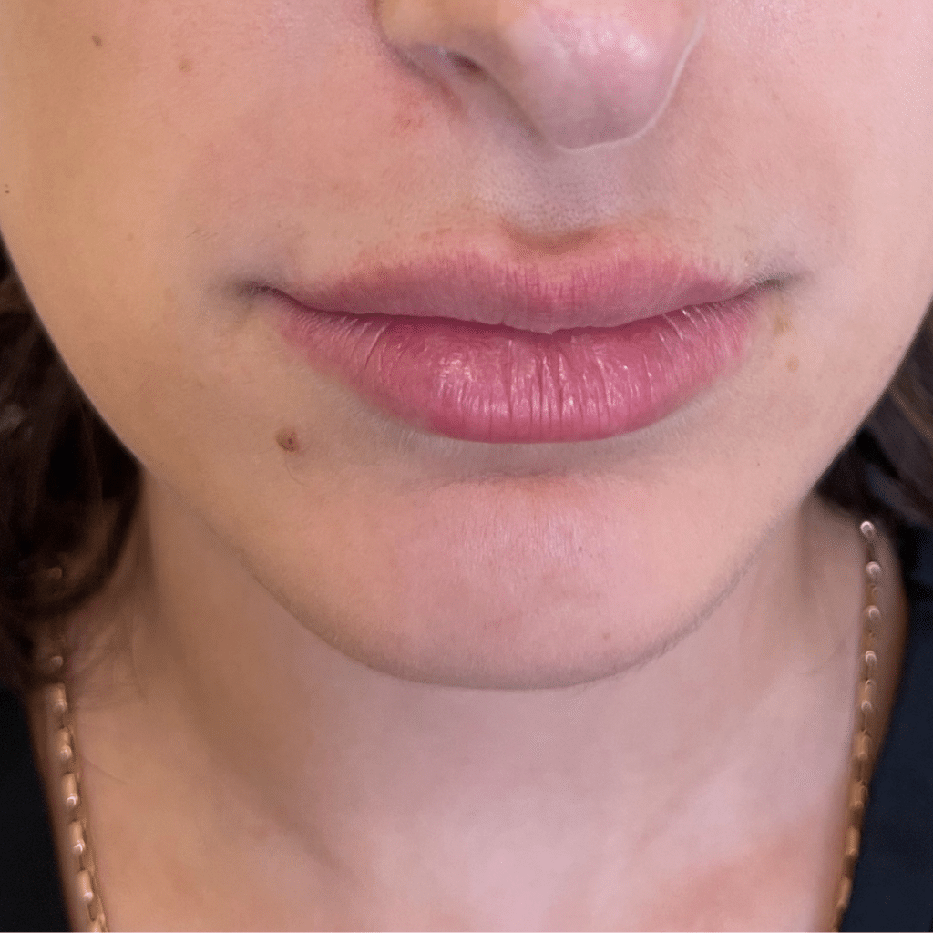 RHA Filler Beverly Hills CA - Resilient Hyaluronic Acid