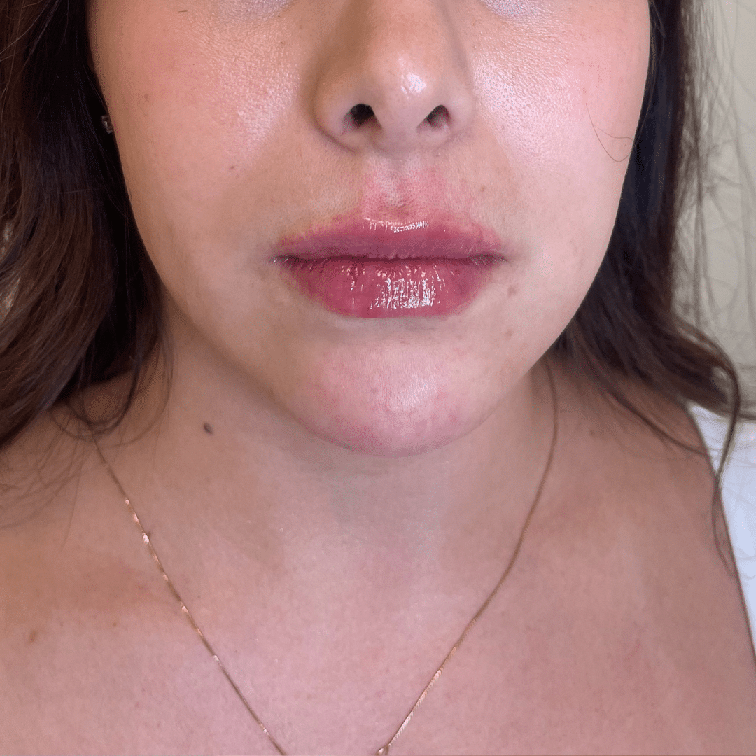 RHA Filler Beverly Hills CA - Resilient Hyaluronic Acid